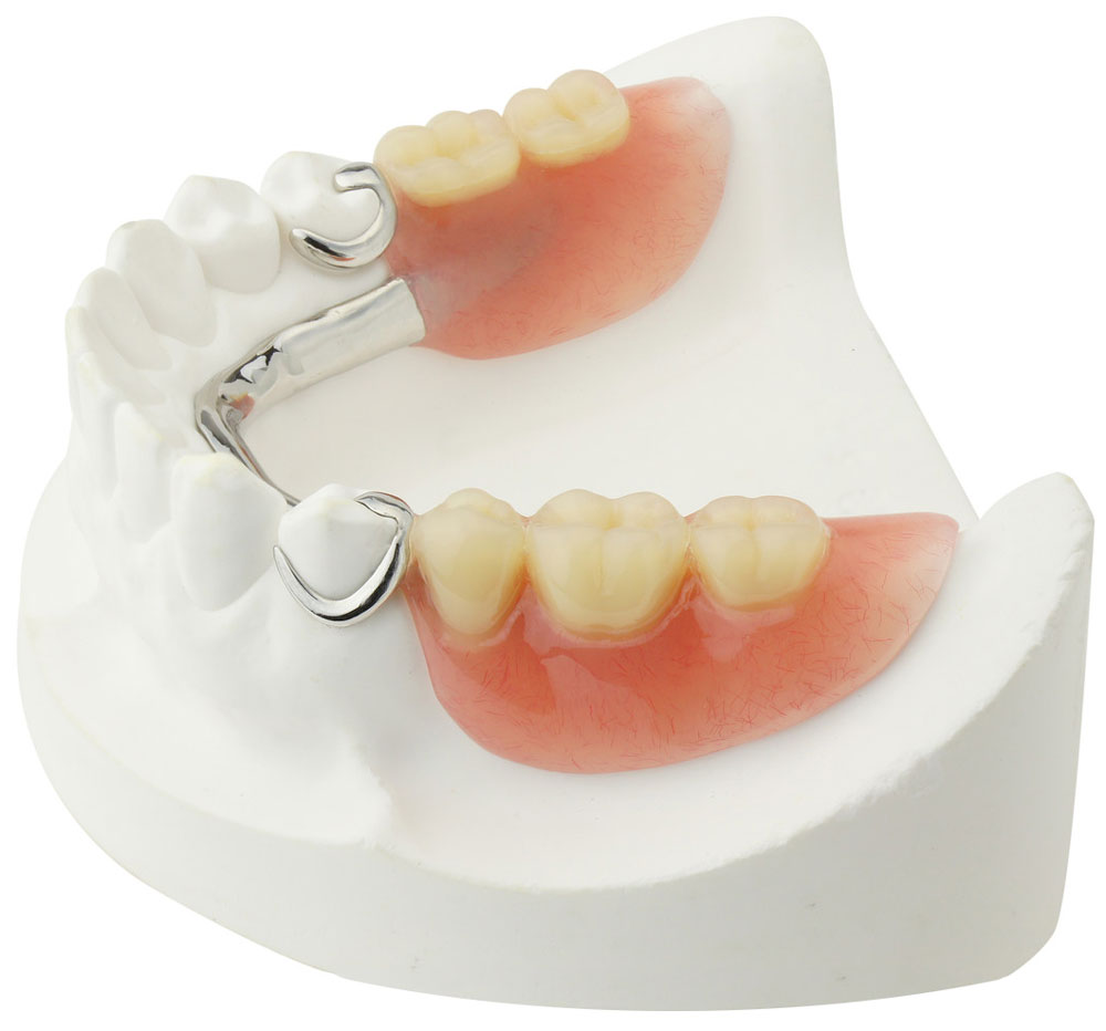 Wauwatosa Bridges & Partial Dentures | Accepting New Patients!