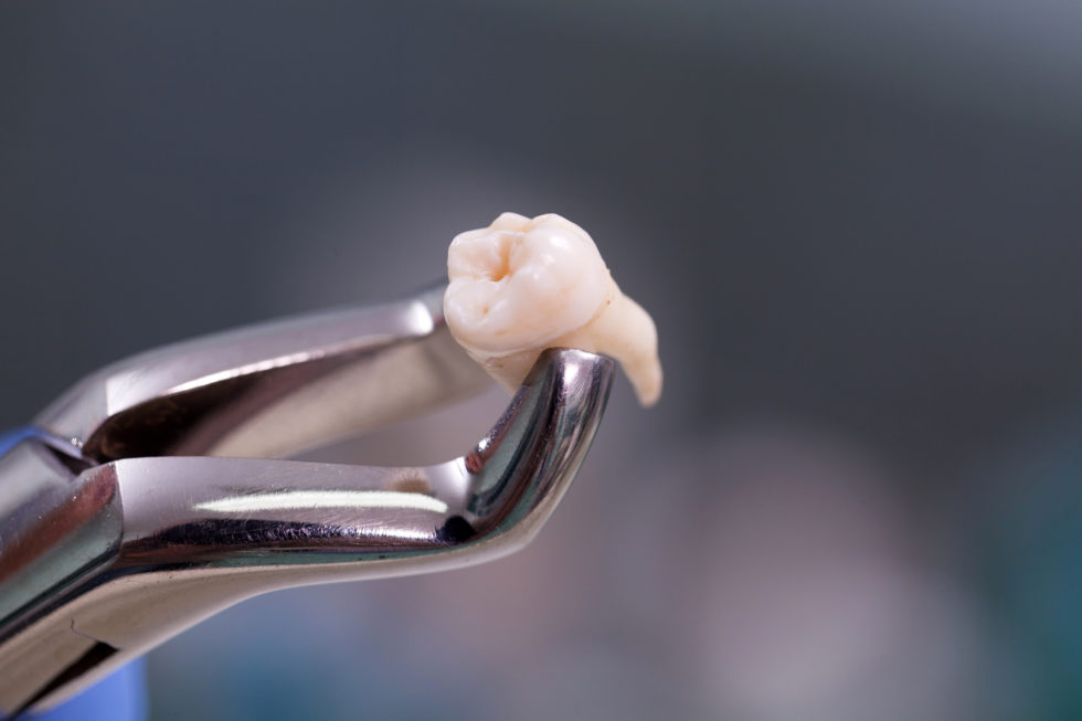 Tooth Extraction Healing Timeline: What to Expect - McCue Dental Health